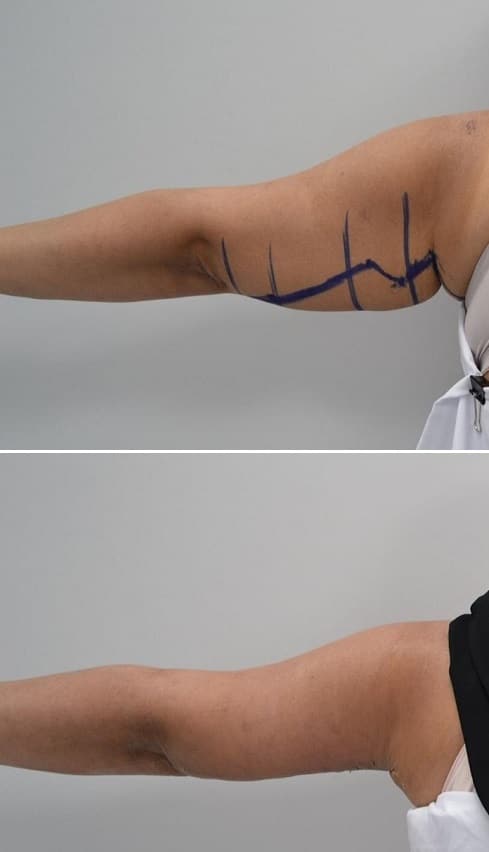 Arm Lift | Brachioplasty in Lima - Surgery in Peru