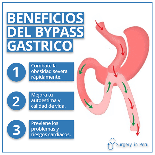 Bypass Gástrico en Lima, Perú - Elimine La Obesidad con Surgery in Peru