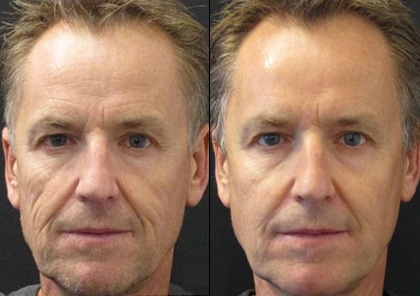 Collagen Biostimulators - Surgery in Peru