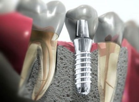 Digital Implantology - Dental Implants in Lima | 3D Surgery in Peru