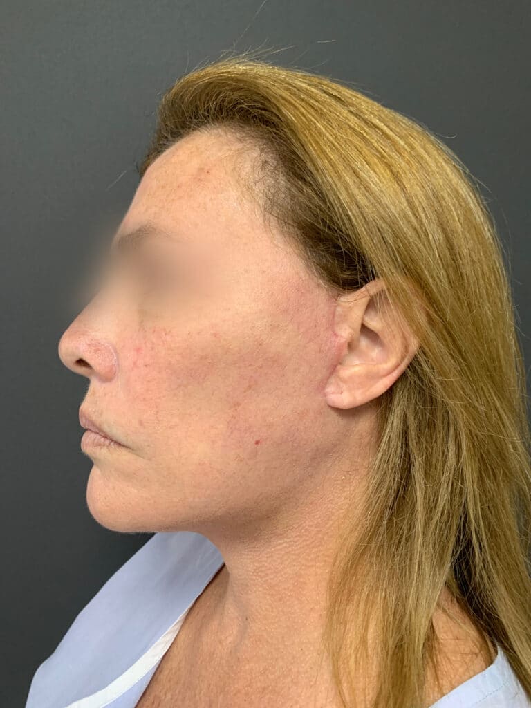 Endolifting Laser in Peru & Endolight | Dra Maria Eugenia Ruiz