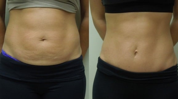 Mini Abdominoplasty en Lima, Peru - Plastic Surgery in Peru