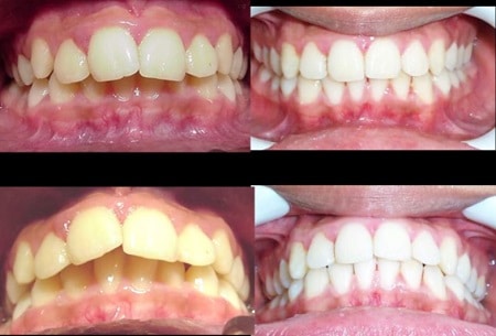 Brackets Before & After Images | Orthodontics, Surgery in Peru