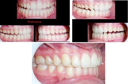 Brackets Before & After Images | Orthodontics, Surgery in Peru