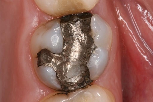 Safe Removal of Amalgam Fillings - Dental Treatment in Lima, Peru