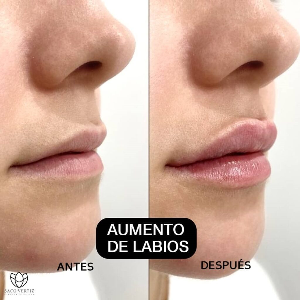 Facial Rejuvenation in Lima with Dr Daniel Saco-Vertiz.