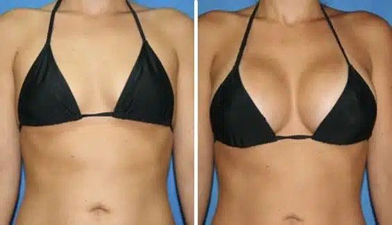 D Cup Breast Implants