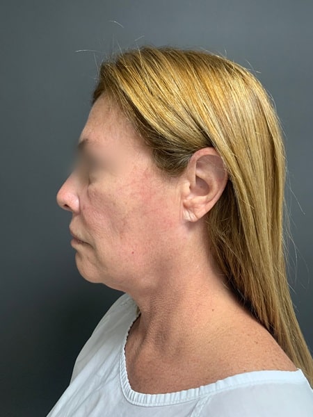 Deep Plane Lifting Facial en Lima - Cirugía Plástica Especializada