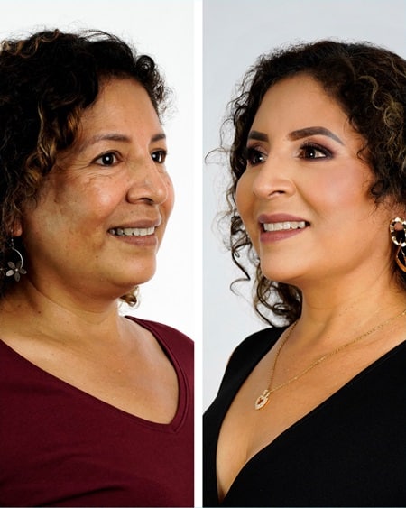 Endolifting Láser | Endolight Lift: Surgery in Peru