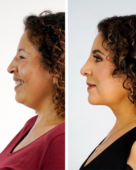 Endolifting Láser | Endolight Lift: Surgery in Peru