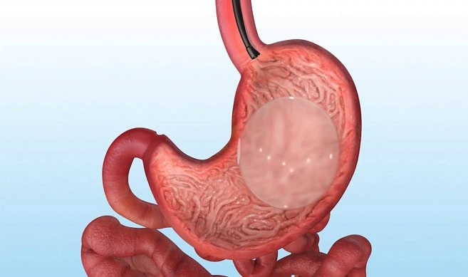 Intragastric Balloon Therapy - Weight Loss Treatment in Lima, Peru