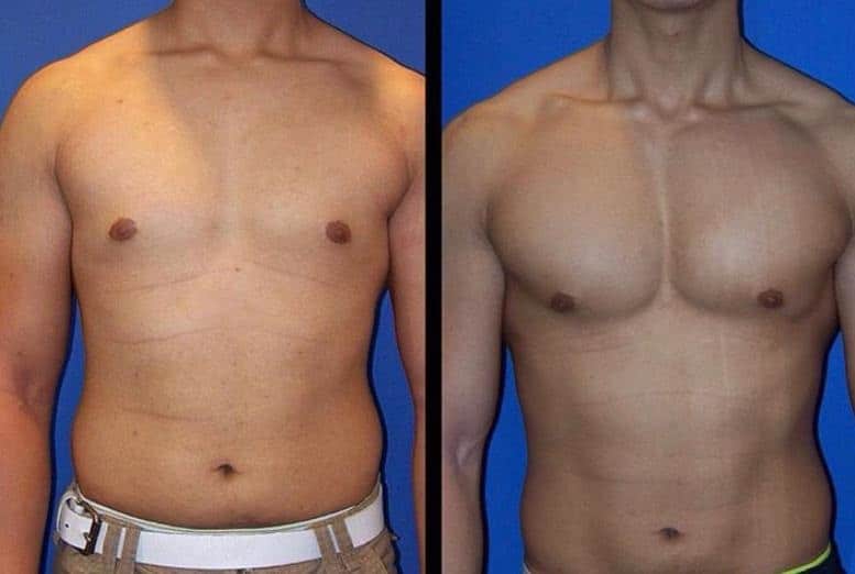 Pectoral Implants for Muscular Male Chests - Surgery in Peru