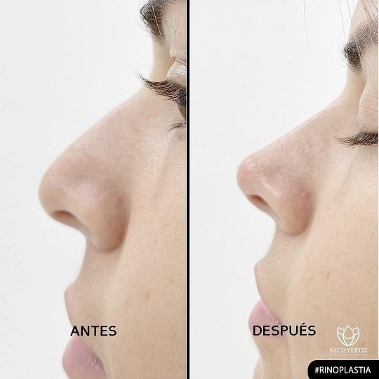 Closed Rhinoplasty Esthetic Surgery Nose Surgery - Surgery in Peru