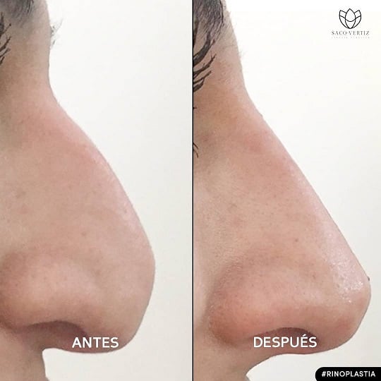 Rhinoplasty Nose Surgery - English Speaking Plastic Surgery in Lima Peru