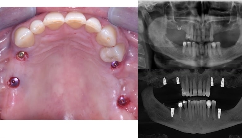 Sinus Lift, Bone Graft, & Dental Implants Simultaneously - Surgery in Peru
