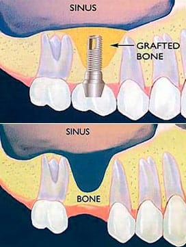 Sinus Lift, Bone Graft, & Dental Implants Simultaneously - Surgery in Peru